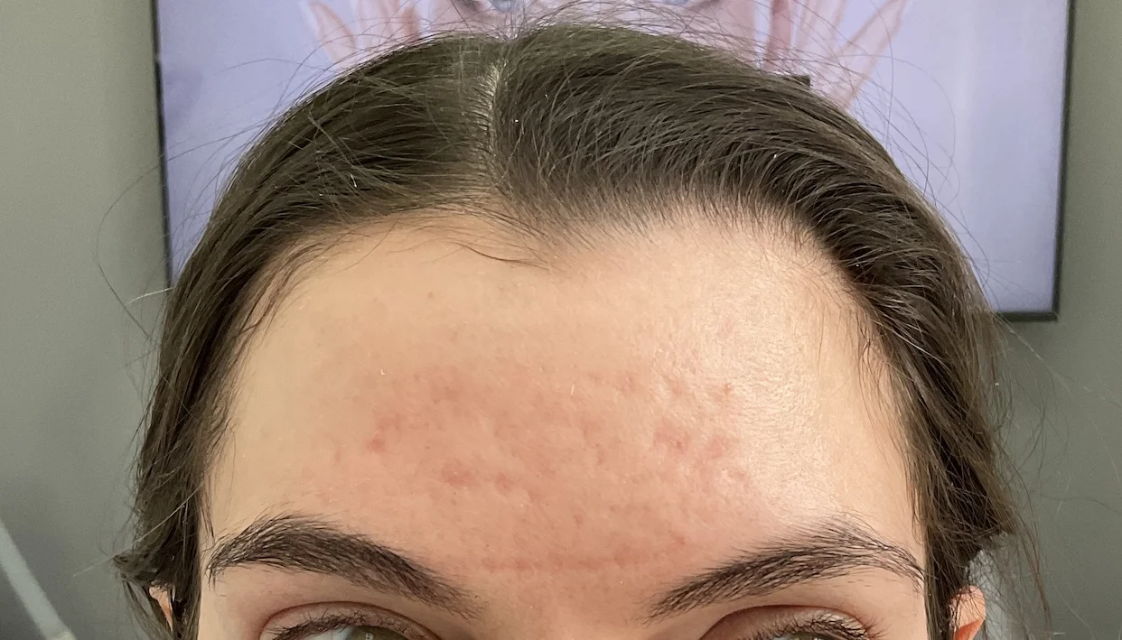 Acne Scars Forehead